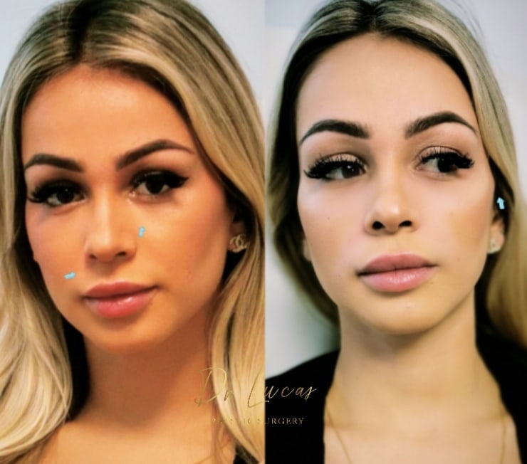 Correction des sillons nasogéniens à Genève | Dr Lucas