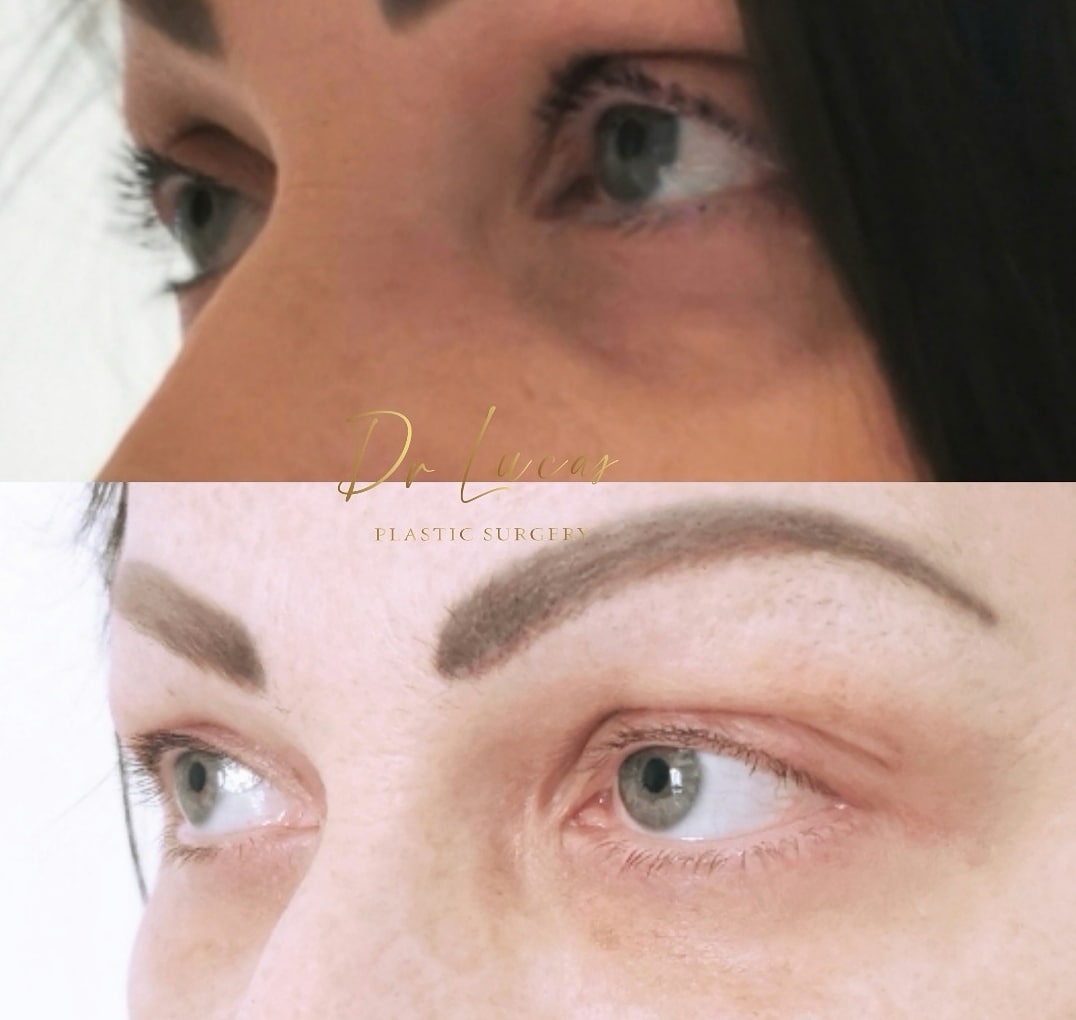 Facial rejuvenation by “nanofat transfer” lipofilling