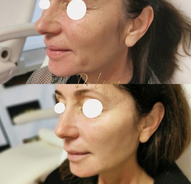 Jawline contouring par acide hyaluronique Genève | Dr Lucas