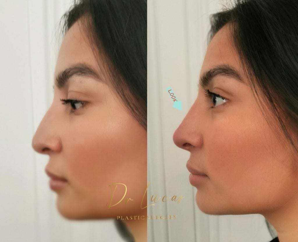 Rhinoplastie Médicale | Acide Hyaluronique ou Fils Tenseurs – Dr Lucas