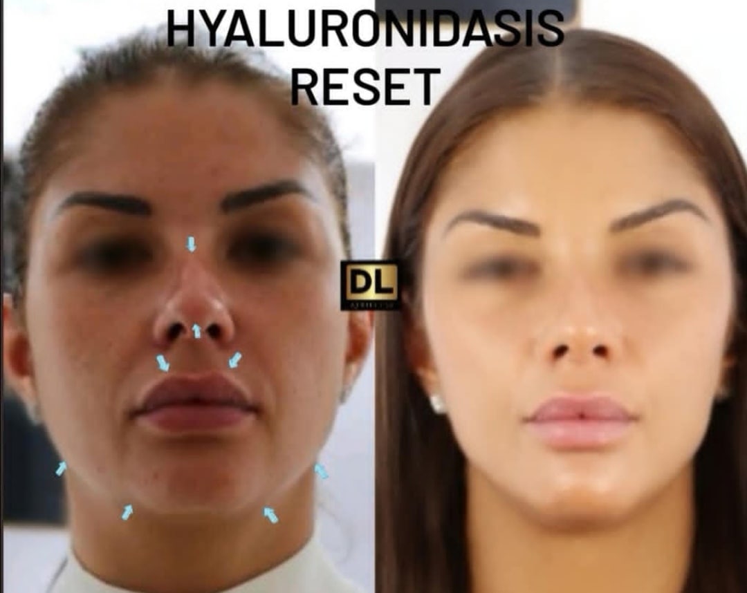 Hyaluronidase injection in Geneva | Dr Lucas Plastic Surgery