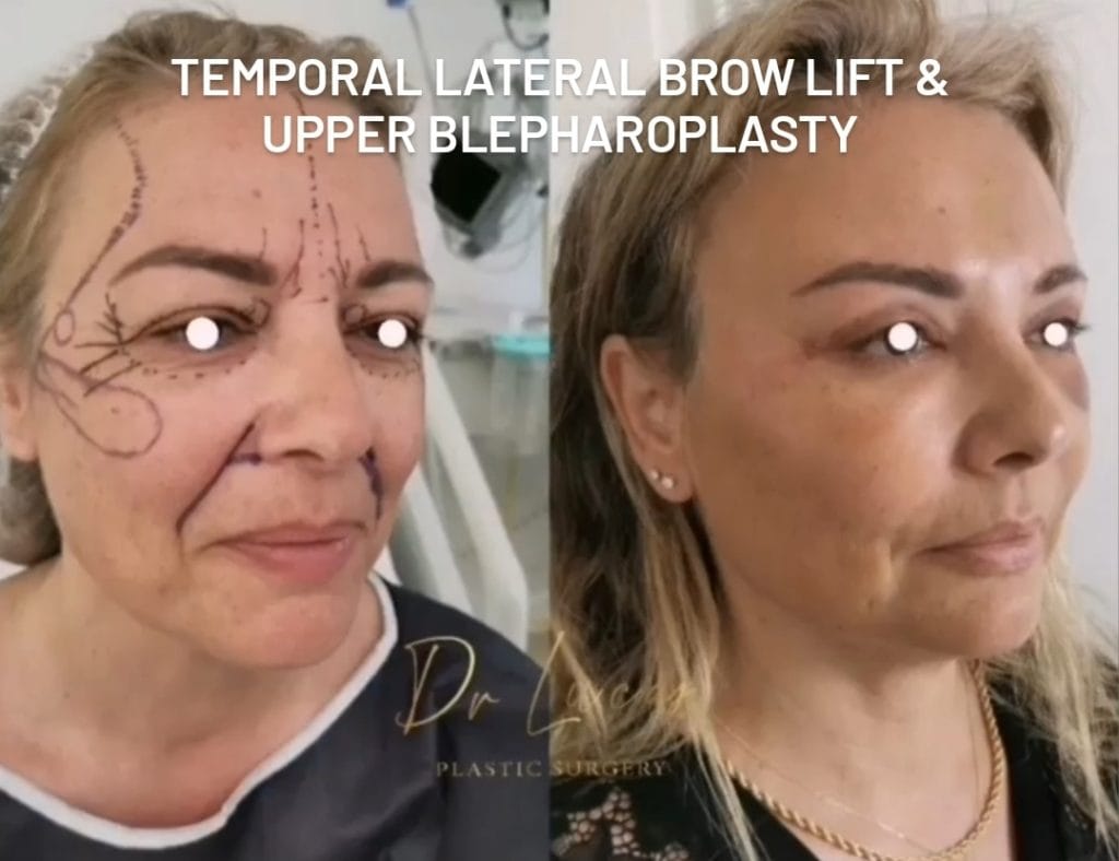 Upper and Lower Blepharoplasty | Dr Lucas Plastic Surgery