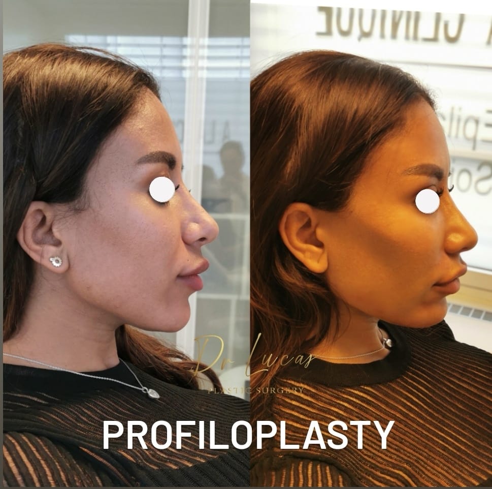 Augmentation des pommettes | Liposuccion des pommettes