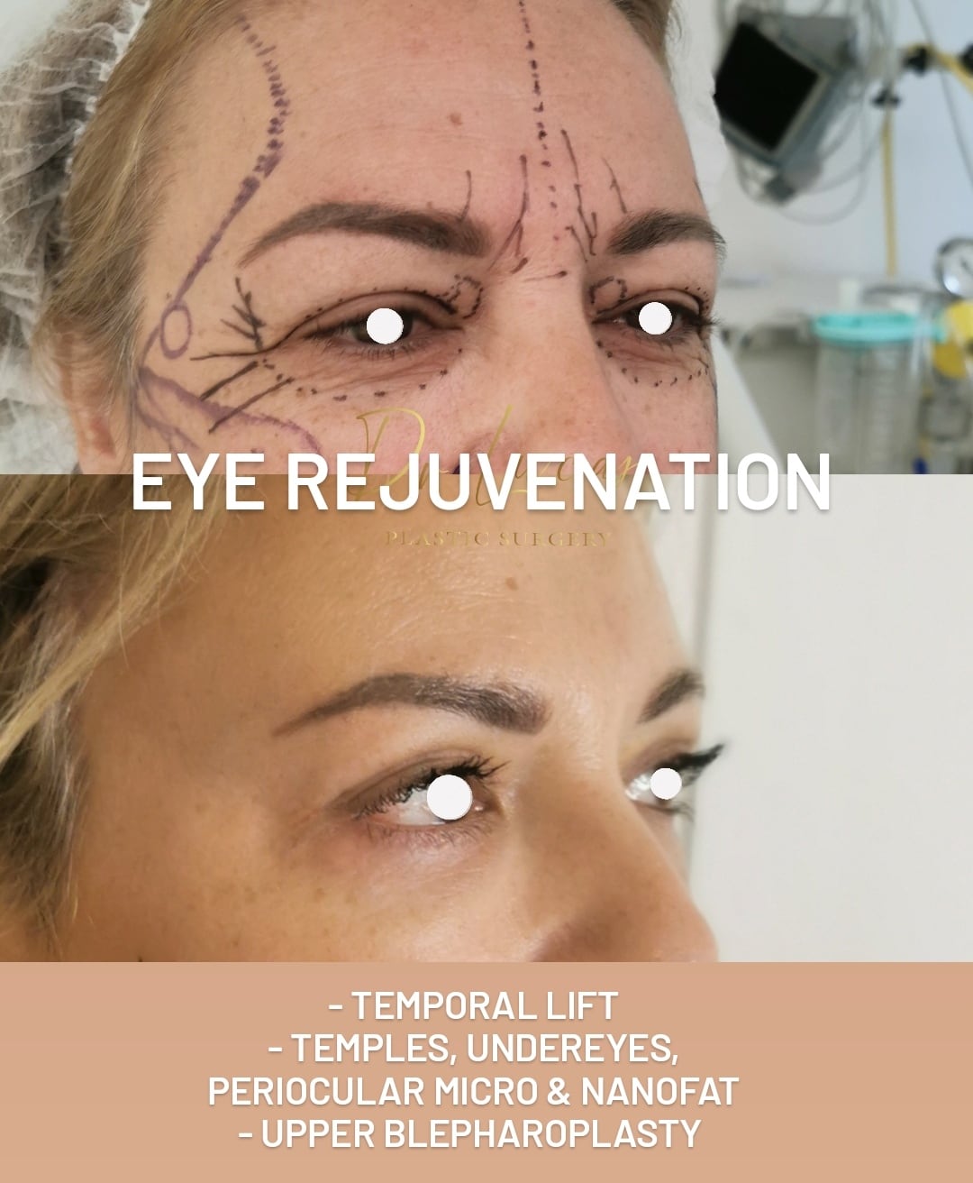 Canthopexy » Cat Eyes » by threads or surgery in Geneva