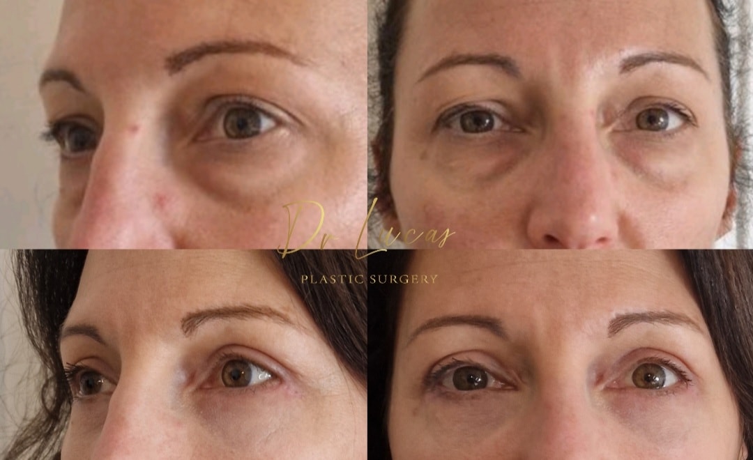 Upper and Lower Blepharoplasty | Dr Lucas Plastic Surgery