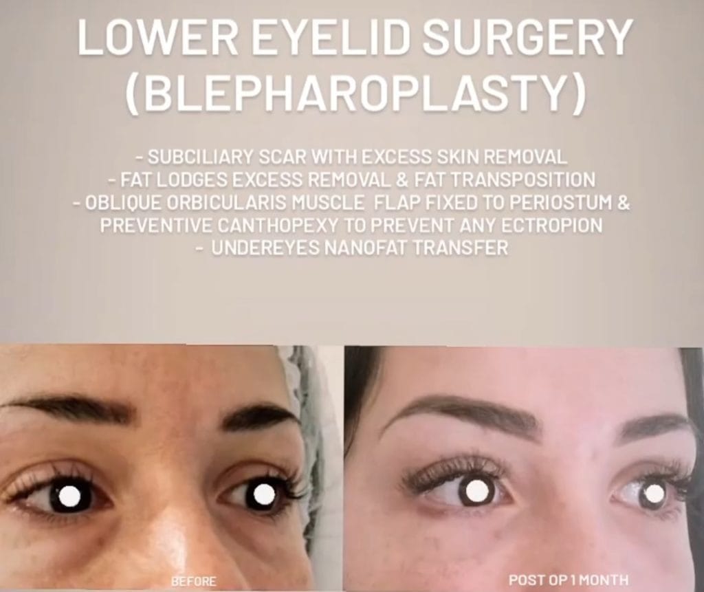 Upper and Lower Blepharoplasty | Dr Lucas Plastic Surgery