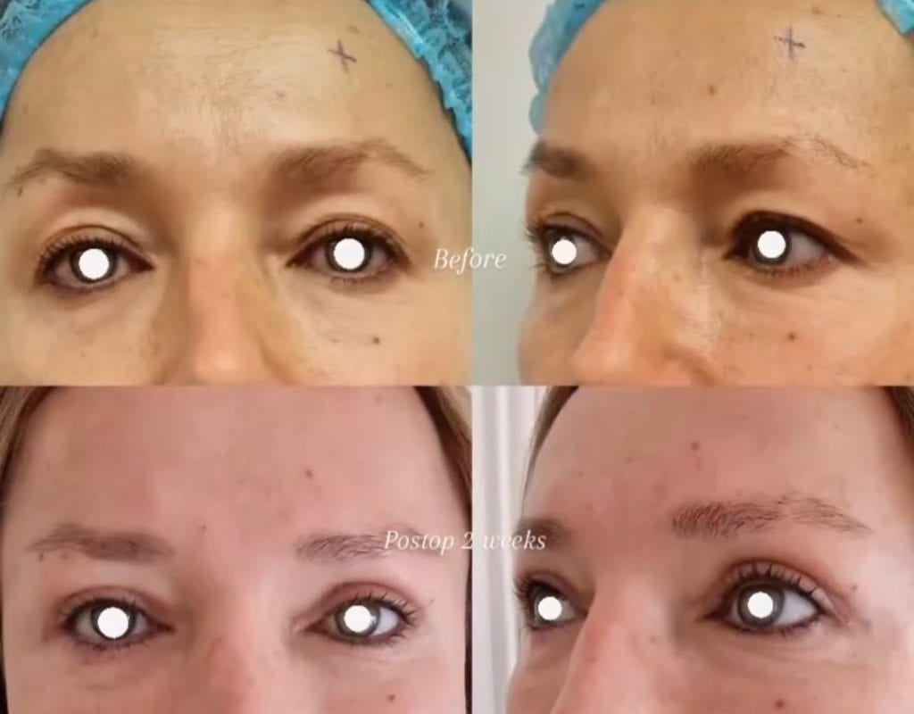 Upper and Lower Blepharoplasty | Dr Lucas Plastic Surgery