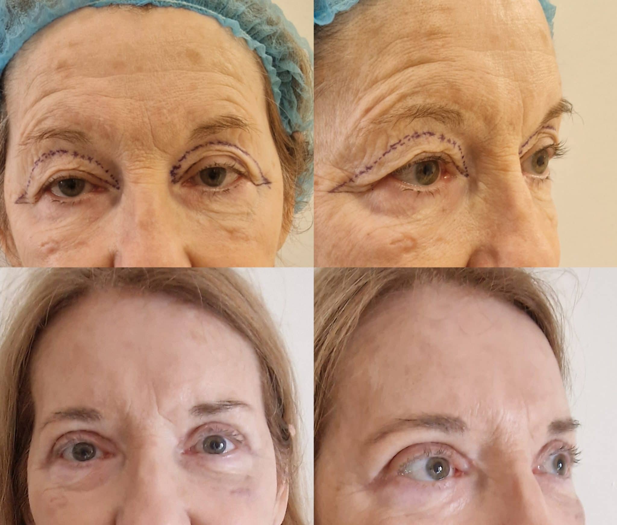 Upper and Lower Blepharoplasty | Dr Lucas Plastic Surgery