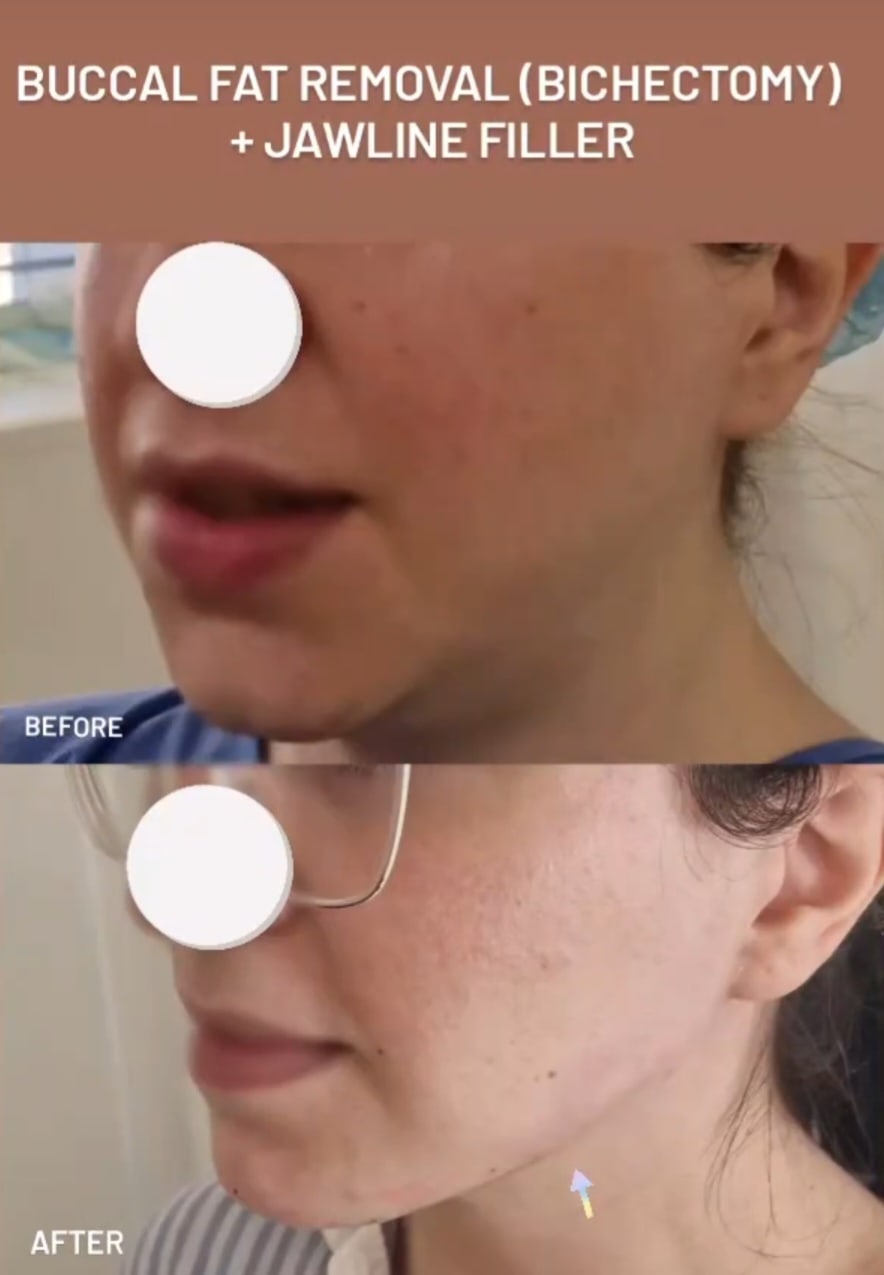 Bichectomie (ablation des boules de Bichat), Genève | Dr Lucas